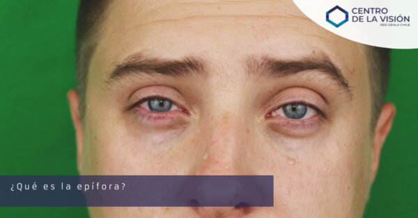 ¿Qué es la epífora? - Centro de la Visión
