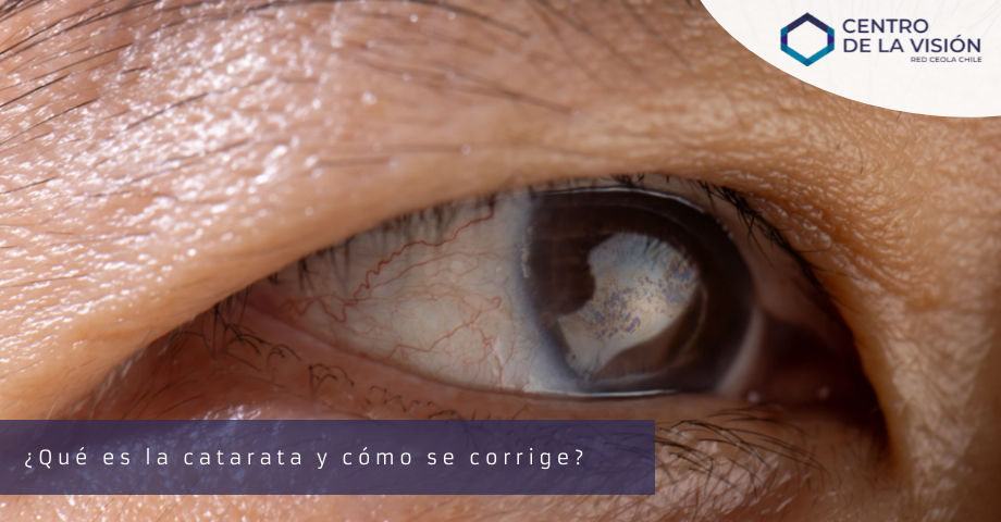 ¿Qué es la catarata y cómo se corrige? - Centro de la Visión